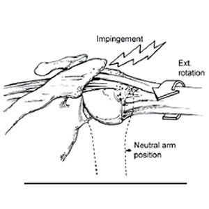 Shoulder Impingement Syndromes | Shoulder Made Simple™